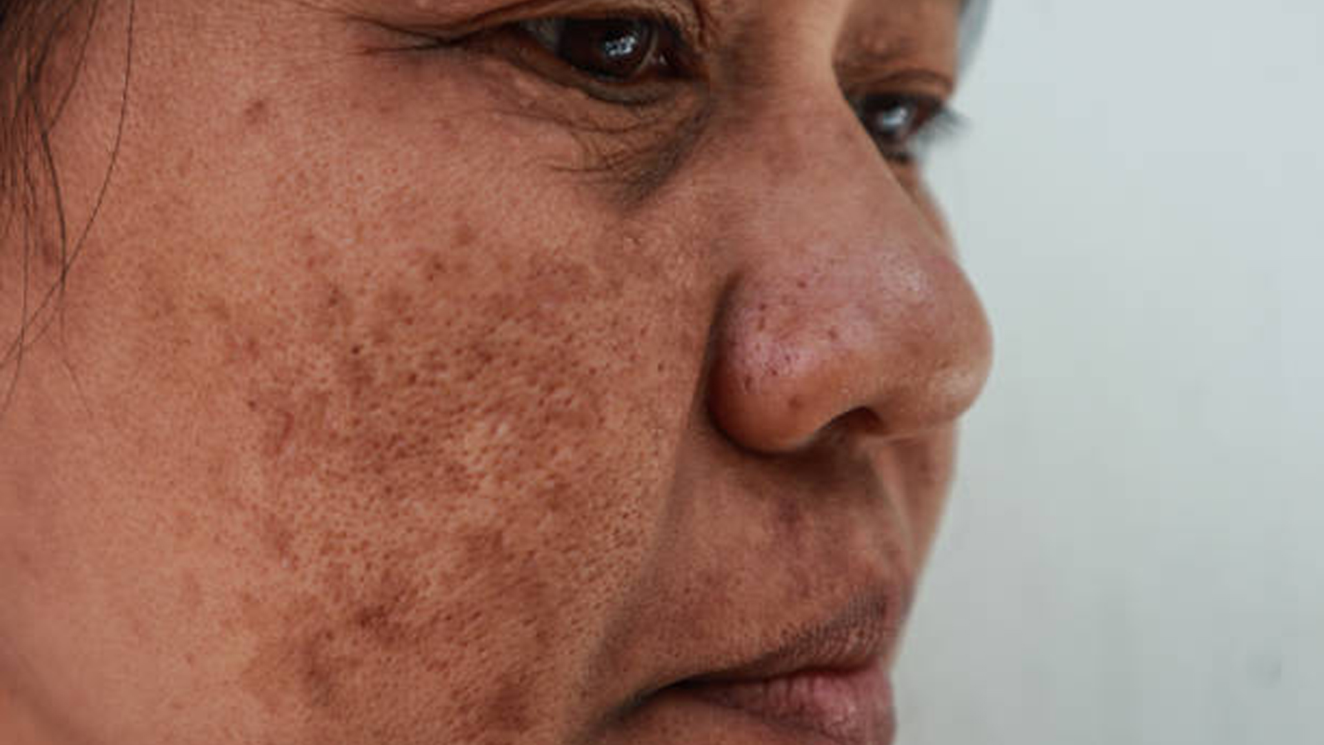 Melasma, Pigmentation And Dark Spots - SkinAngel